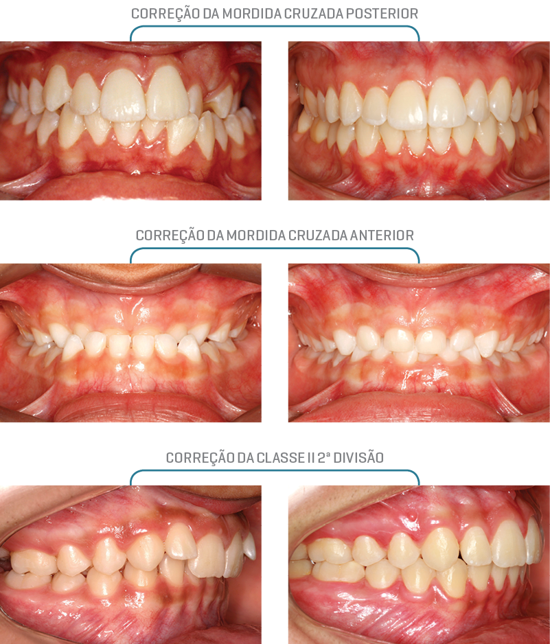 Ortopedia Funcional dos Maxilares
